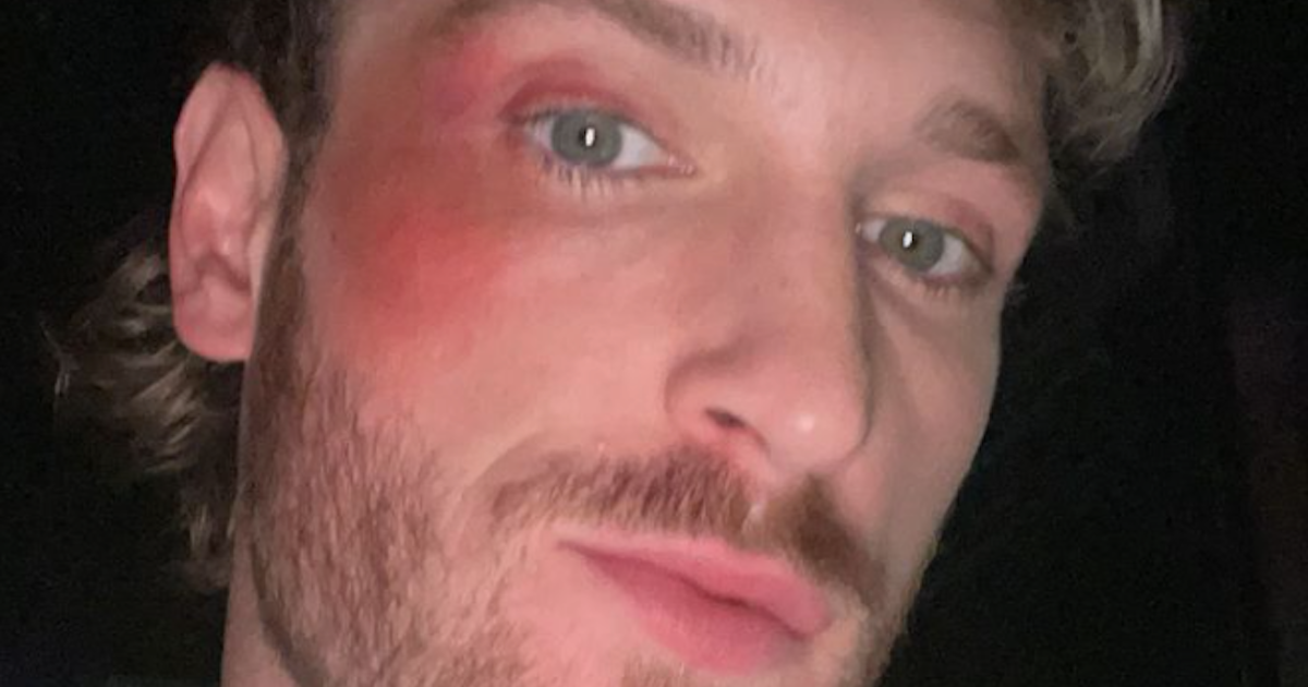 Logan Paul Gets Punched in Face by Rival, Shows off Bruise - PopCulture.com
